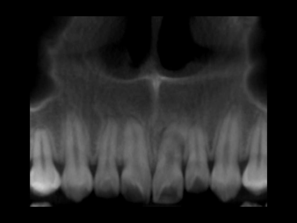 Caso Clínico N°118 - Fractura Radicular - Doi Digital