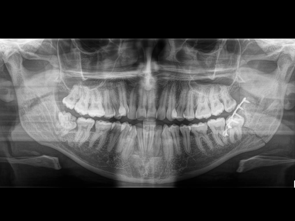 Caso Clínico N° 6: Fractura Mandibular - Doi Digital