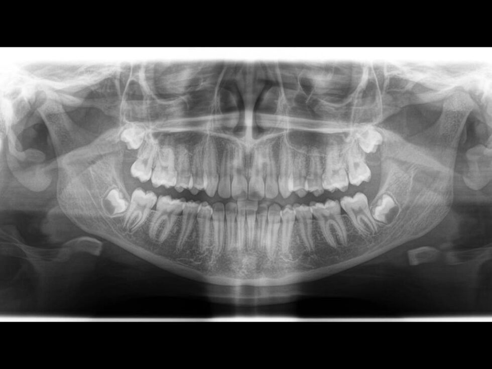 Caso Clínico N°63 Restos Radiculares de Elementos Temporarios - Doi Digital