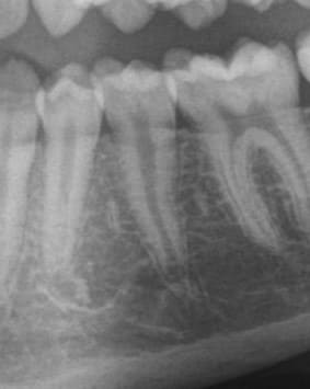 Caso Clínico N°63 Restos Radiculares de Elementos Temporarios - Doi Digital